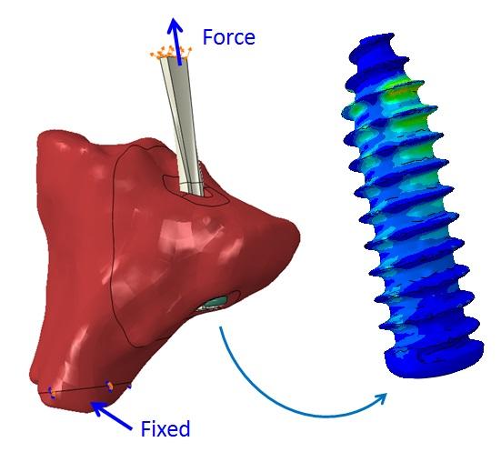 FEA of Absorbable PLLA Bone Screw | Veryst Engineering